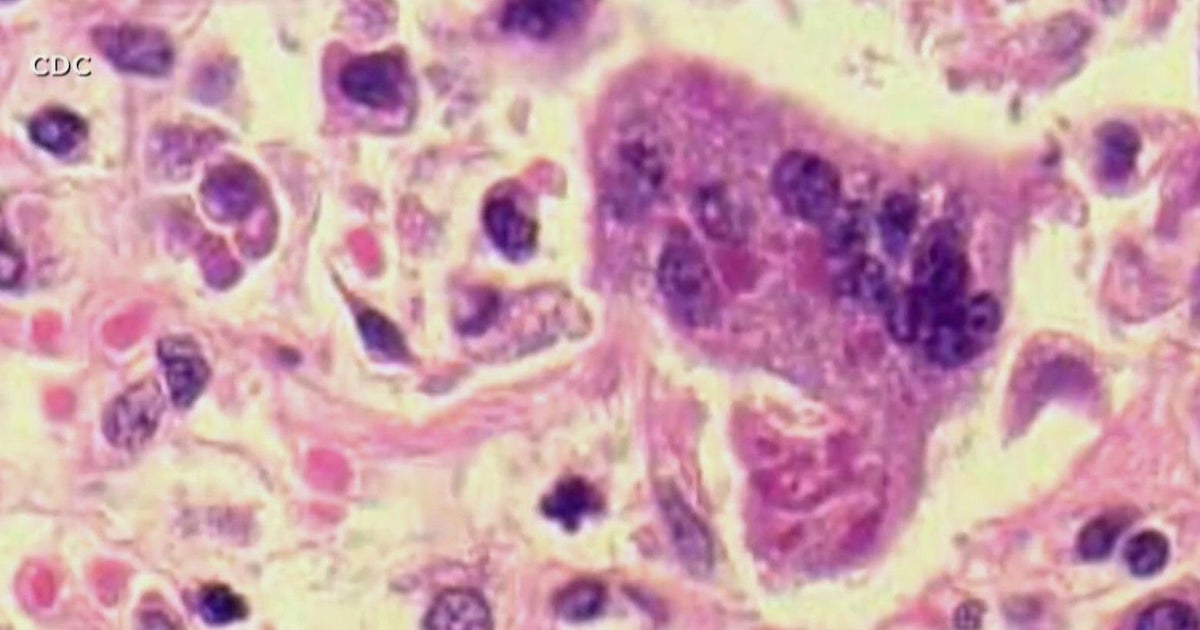 West Virginia confirms first measles case since 2009 - CBS Pittsburgh