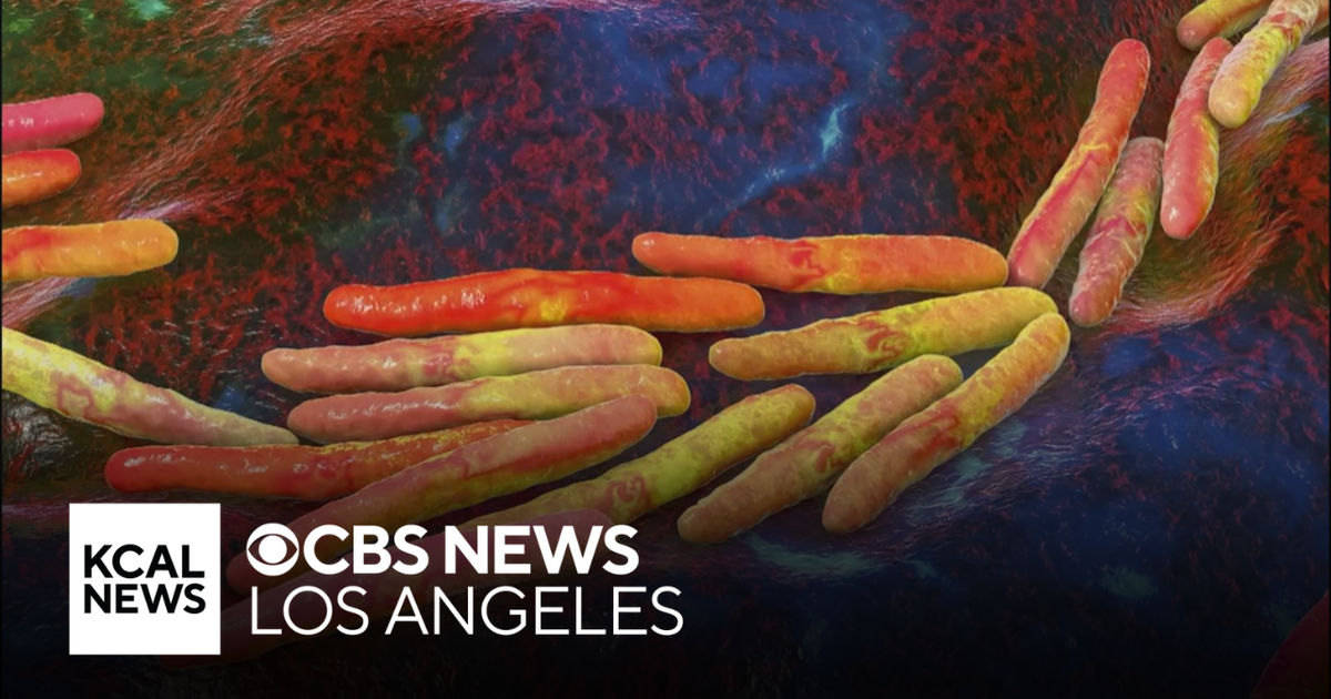 Tuberculosis outbreak kills 1 person in Long Beach - CBS Los Angeles