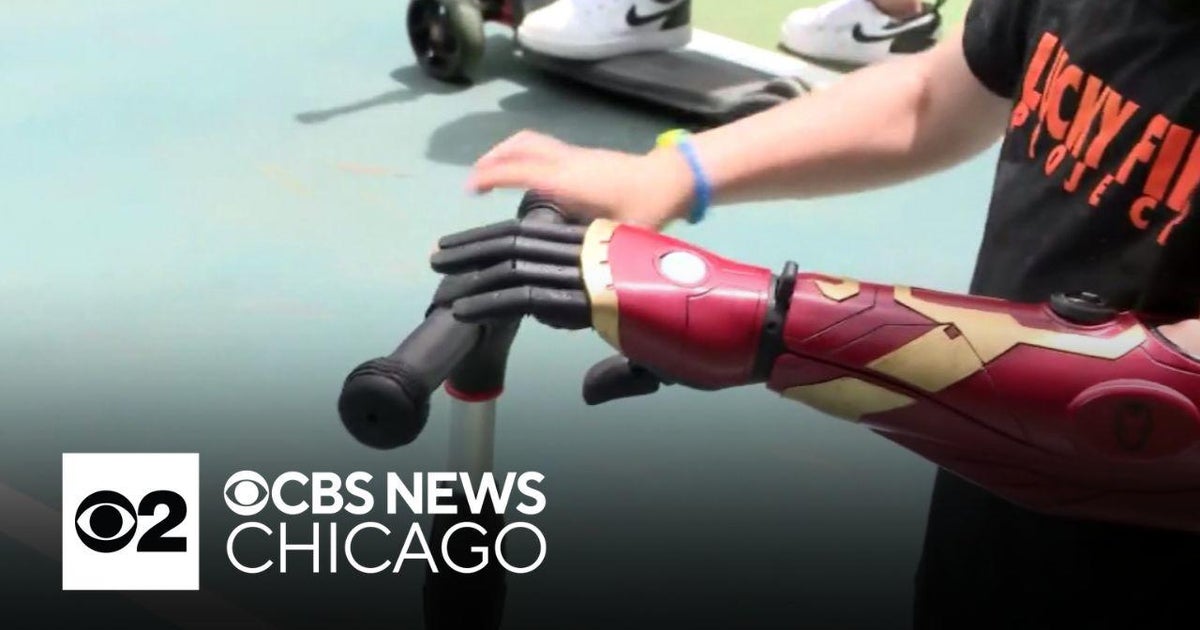 5-year-old boy born without left hand gets "Iron Man" bionic arm - CBS ...