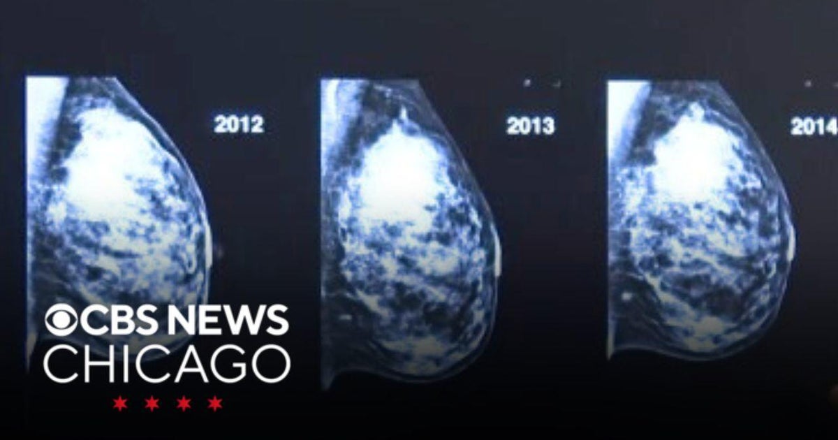 All mammogram results to include assessment of breast density - CBS Chicago