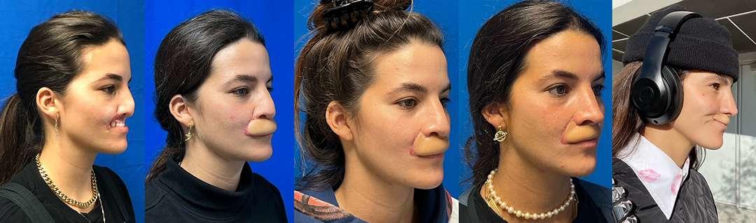 A dog tore off her upper lip. Five surgeries later, she's a voice for ...