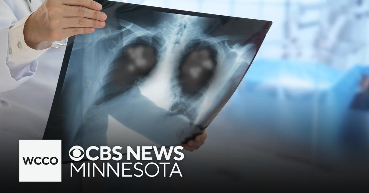 CDC warns of recent spike in walking pneumonia amongst children - CBS ...