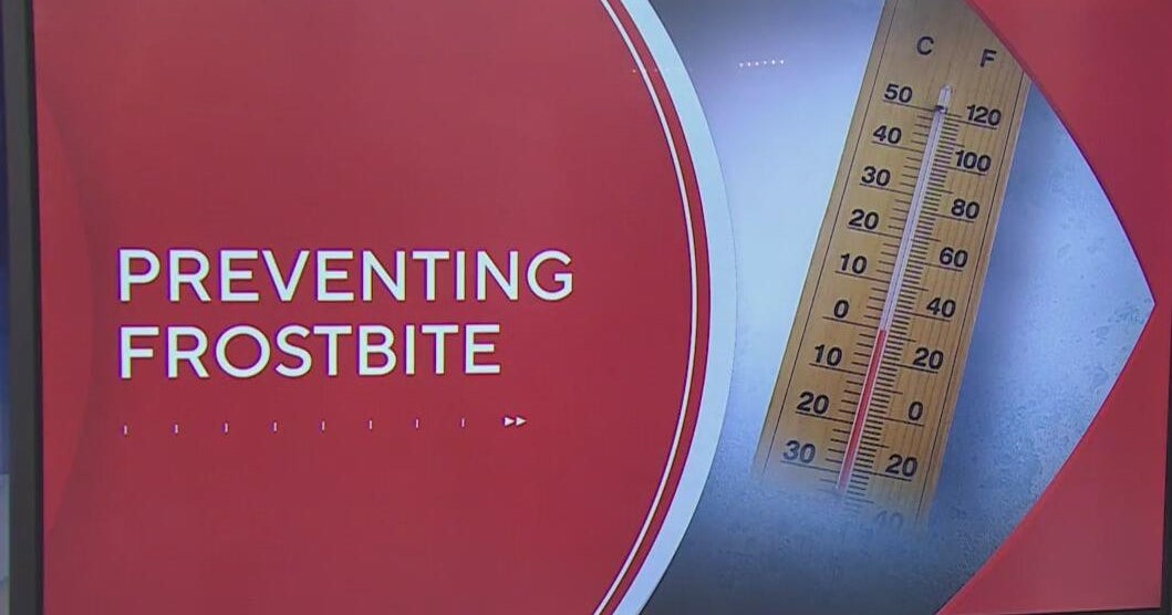 Doctors warn of frostbite as extreme cold hits North Texas - CBS Texas