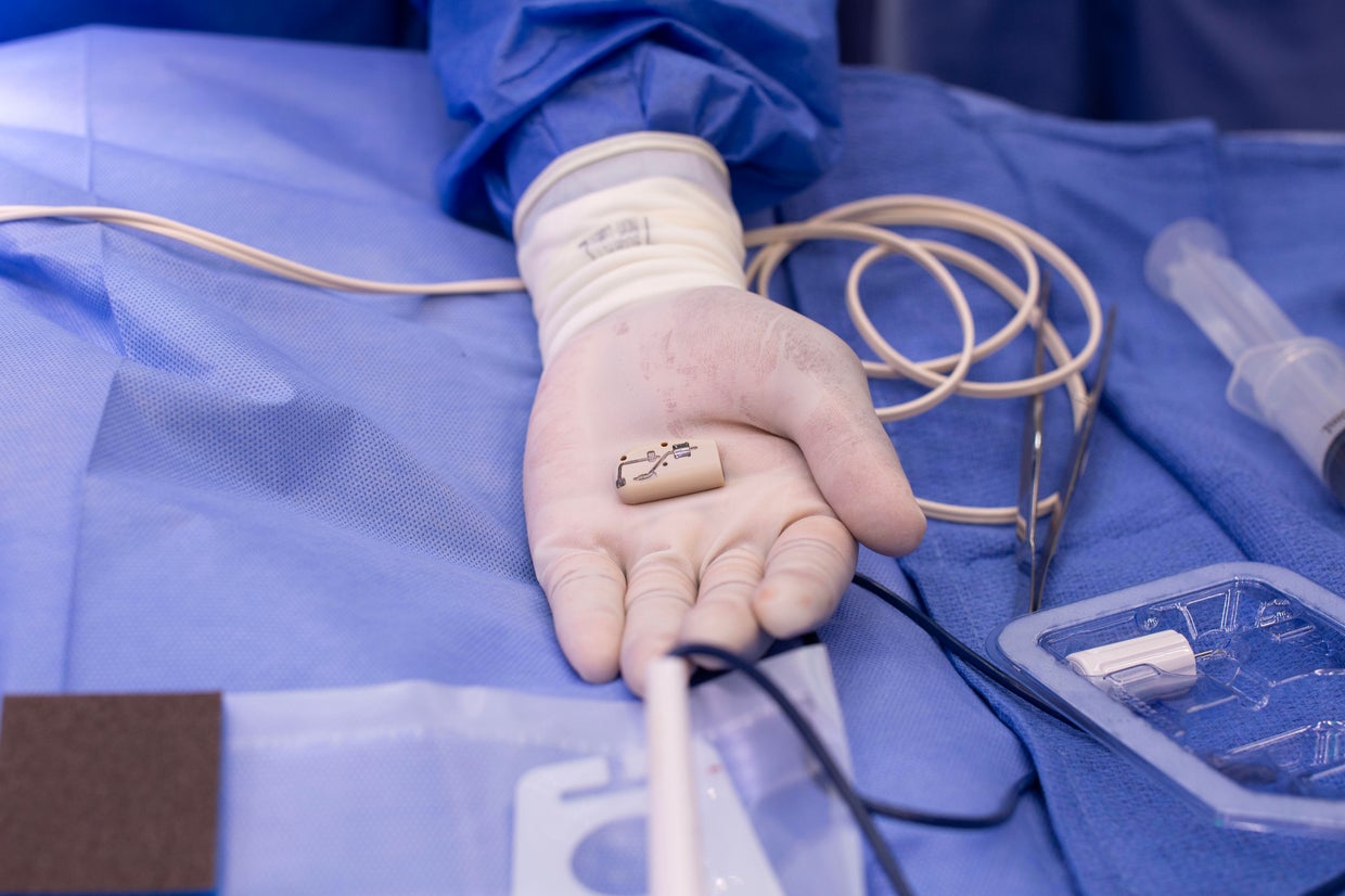 Baby has world's smallest pacemaker implanted to treat dangerous heart ...