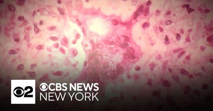 2 confirmed measles cases in NYC, officials say - CBS New York
