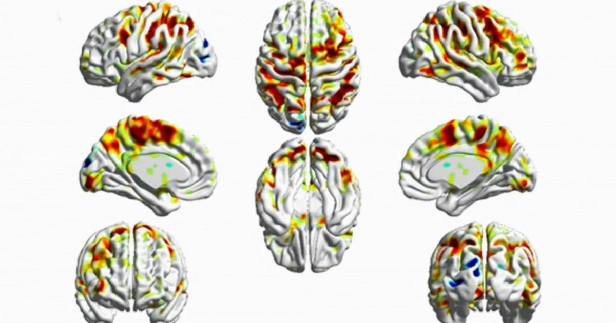 How smartphone addiction may be hurting our brains - CBS News