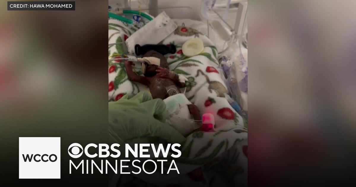How one of the smallest babies ever born overcame extraordinary odds ...