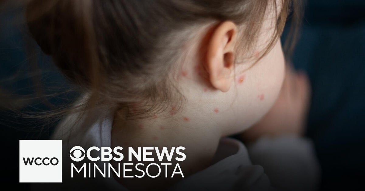 Minnesota sees another case of measles, and more headlines - CBS Minnesota