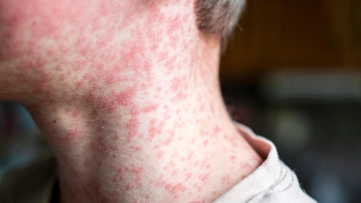 Colorado health officials confirm seventh measles case, on flight with ...