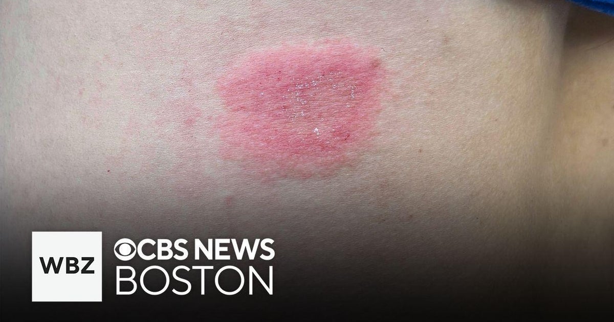 What is ringworm and how is it treated? - CBS Boston