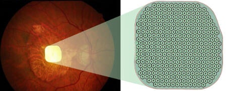 Tiny eye implant, special glasses help some legally blind patients read ...