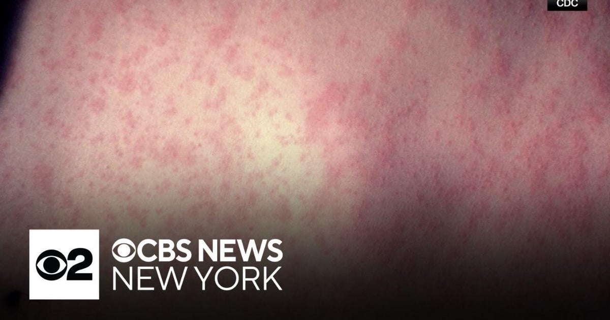 Infant in NYC diagnosed with measles - CBS New York