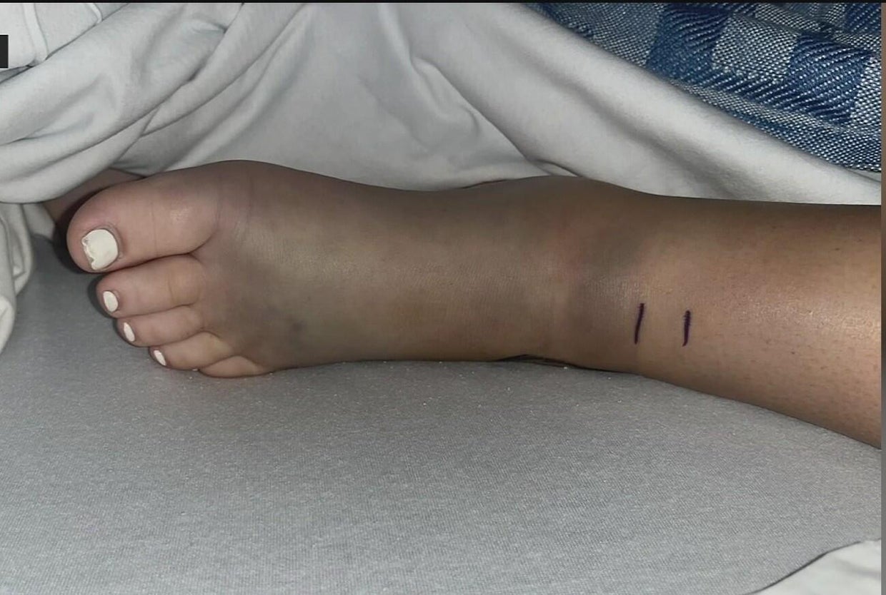 Ventura County 14-year-old recovers from rattlesnake bite - CBS Los Angeles