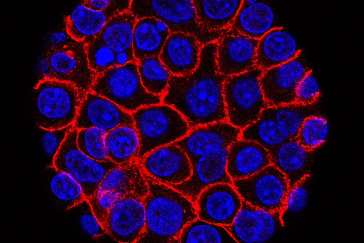 New drug nearly doubles survival rates in some pancreatic cancer ...